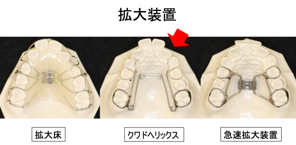 クワドヘリックス｜奈良の矯正歯科なら【おとなとこどもの歯並び 中山矯正歯科・小児歯科 西大寺】